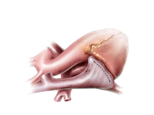 Management of cc tga | PPTX