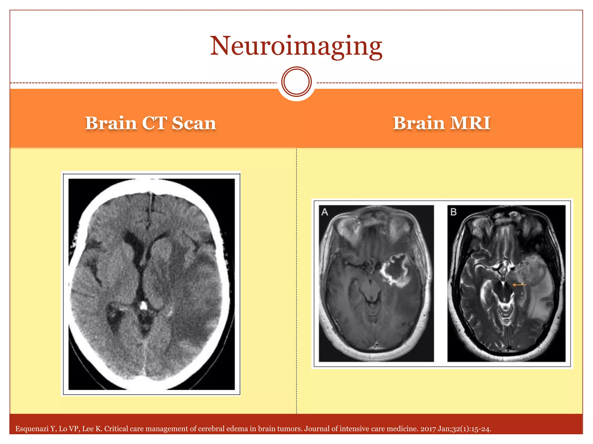 Management of Cerebral Edema in Brain Tumors | PPTX