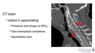 Management of cervical myelopathy VN.pptx