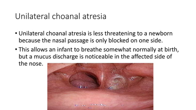 Management of choanal atresia
