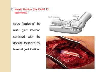 Management of chronic elbow instability 13 | PPTX