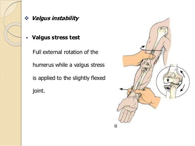 Management of chronic elbow instability 13