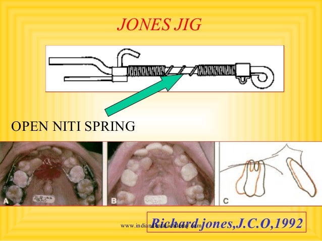 Management of class2.div2 /certified fixed orthodontic courses by I…