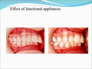Management of class ii division 1 malocclusion | PPT