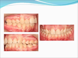 Management of class ii division 1 malocclusion | PPT