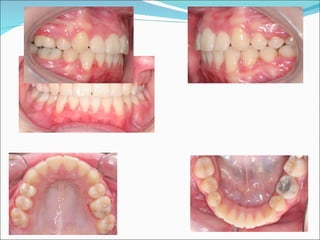Management of class ii division 1 malocclusion | PPT