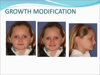 Management of class ii division 1 malocclusion | PPT
