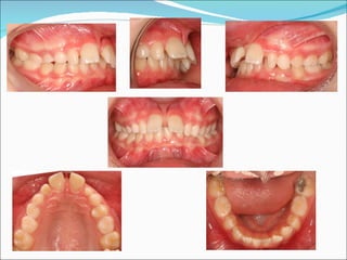 Management Of Class Ii Division 1 Malocclusion Ppt
