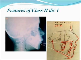 Management of class ii division 1 malocclusion | PPT