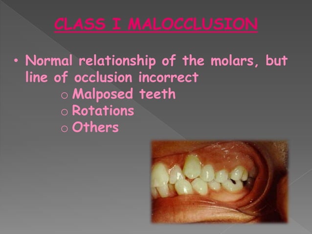 Management of class i malocclusion | PPTX