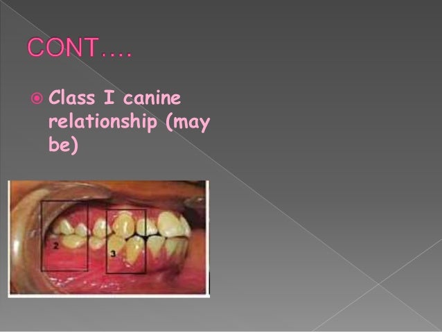 Management of class i malocclusion