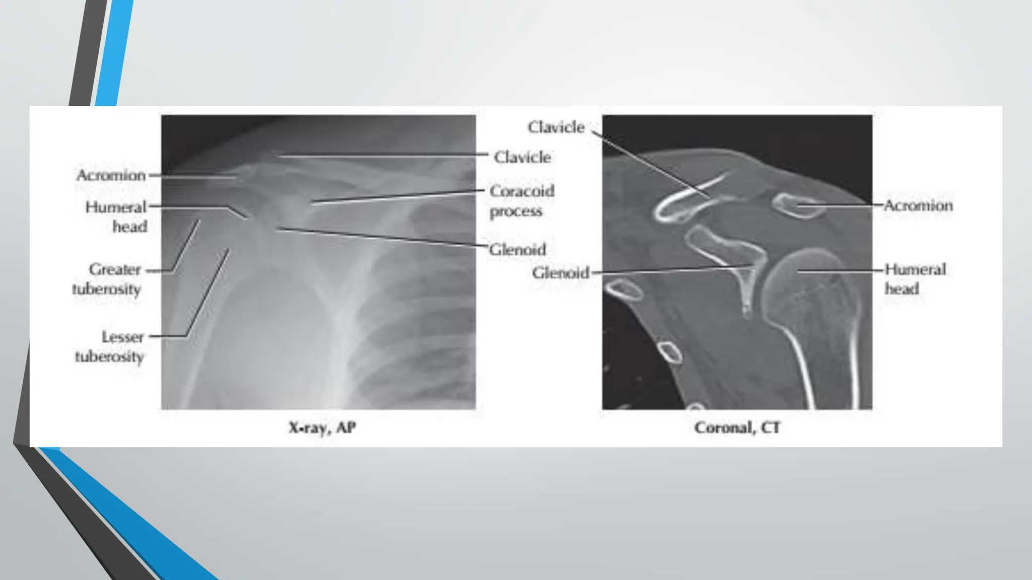 managements of the clavicle fracture.pptx
