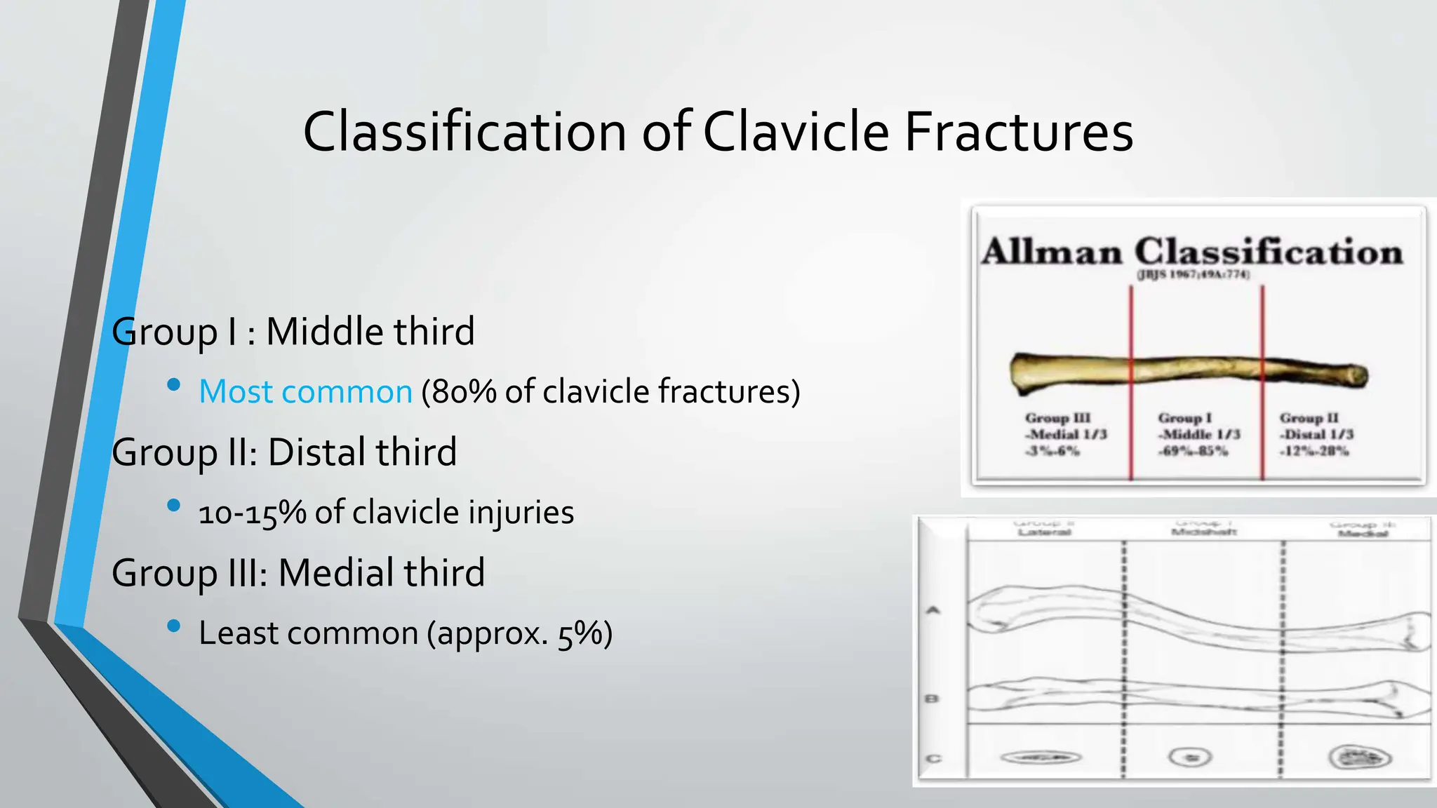managements of the clavicle fracture.pptx