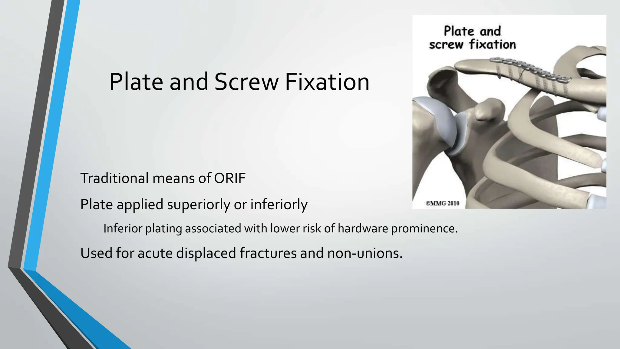 managements of the clavicle fracture.pptx