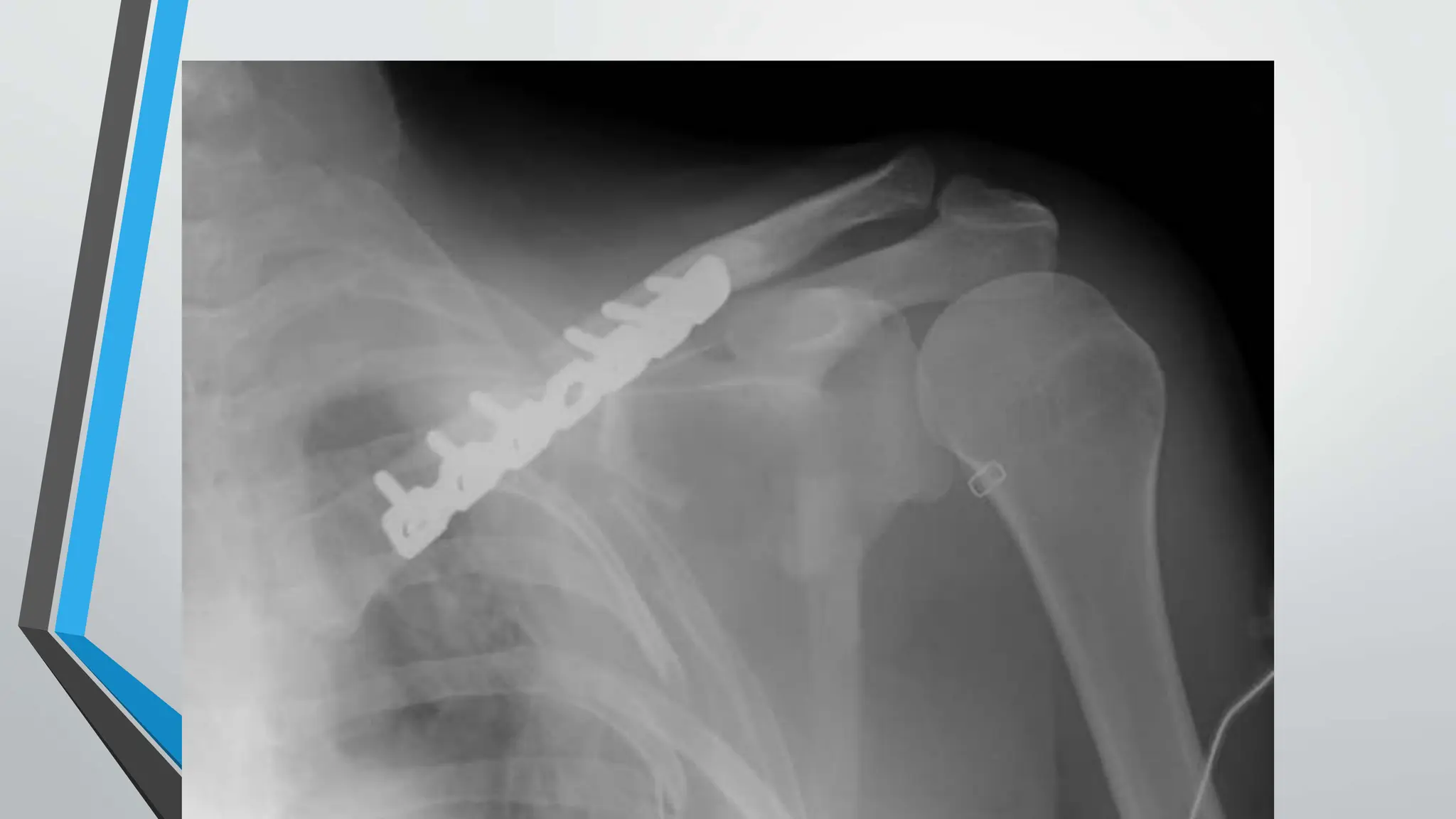 managements of the clavicle fracture.pptx