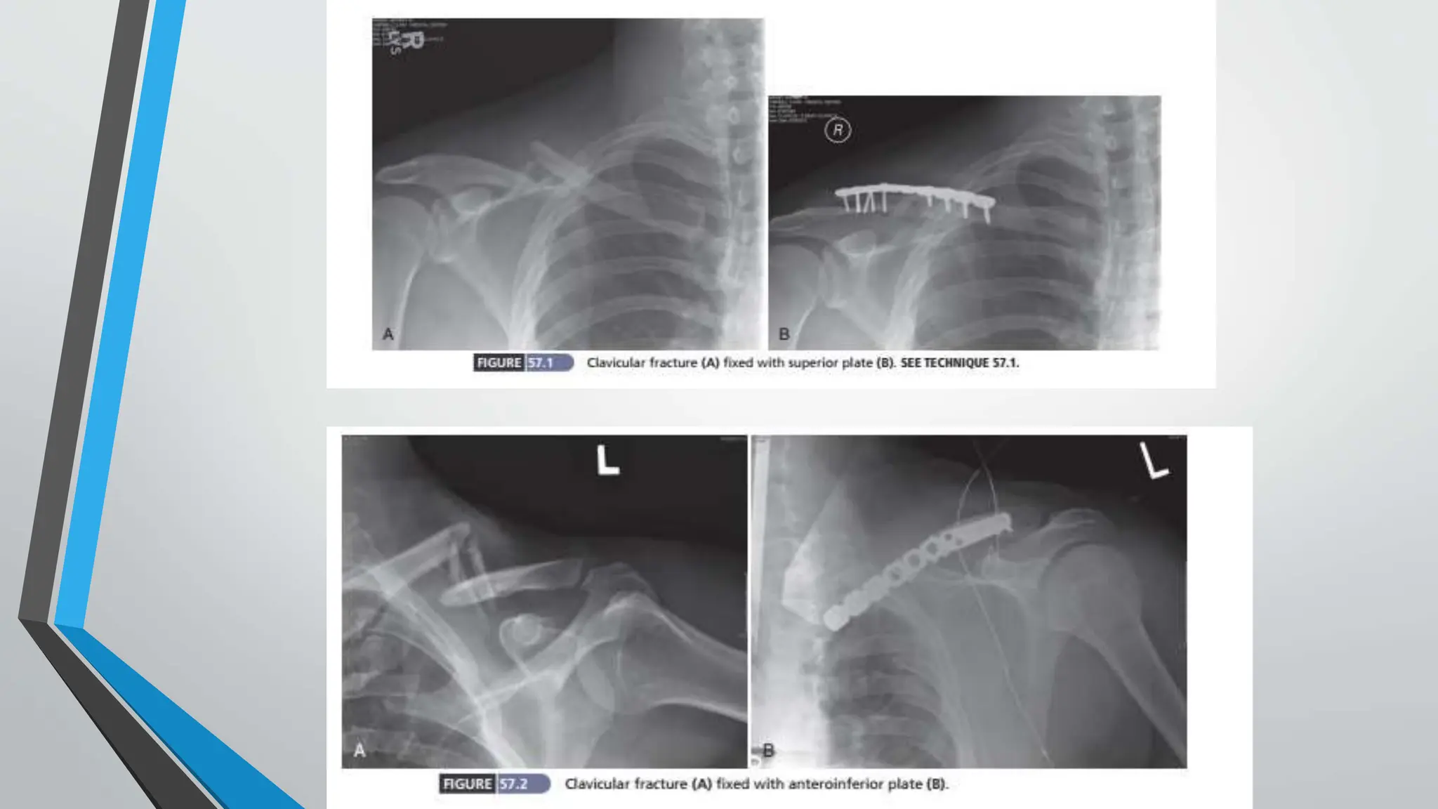 managements of the clavicle fracture.pptx