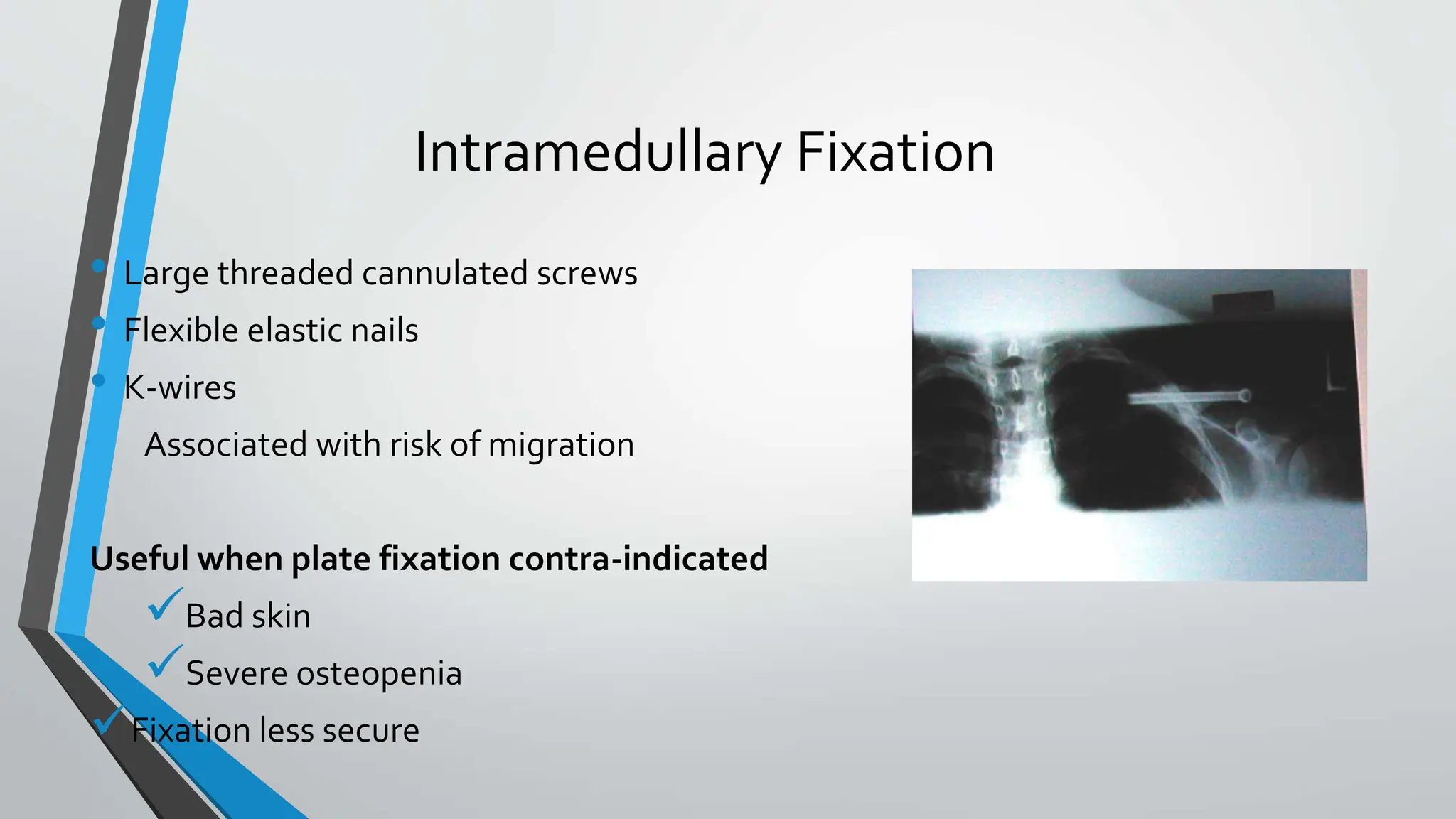 managements of the clavicle fracture.pptx