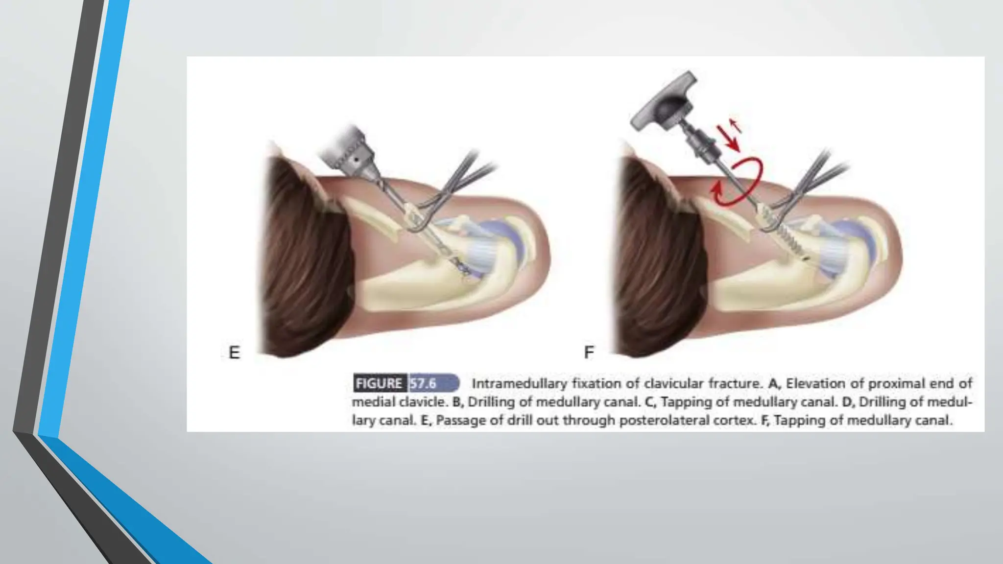 managements of the clavicle fracture.pptx