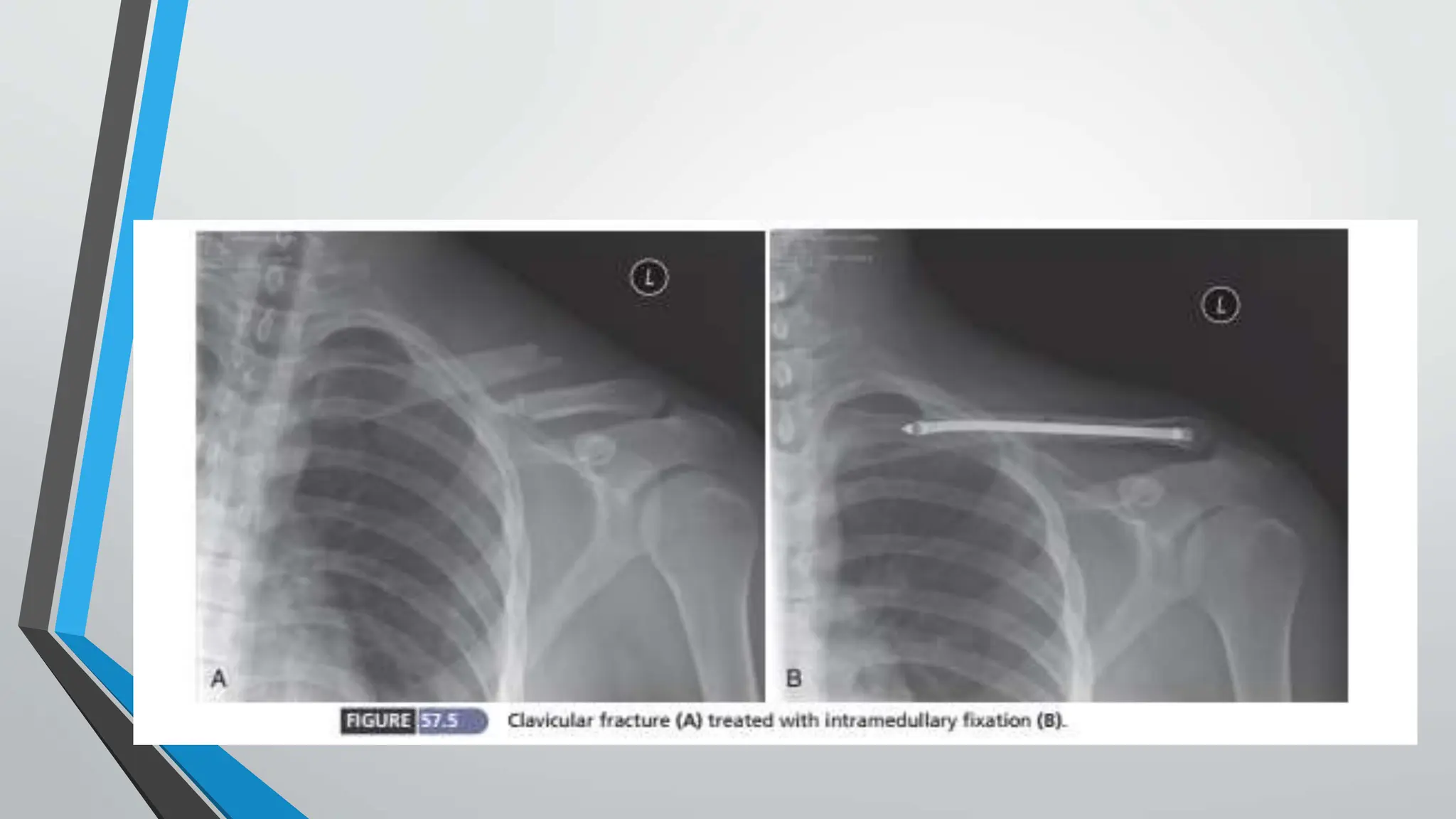 managements of the clavicle fracture.pptx