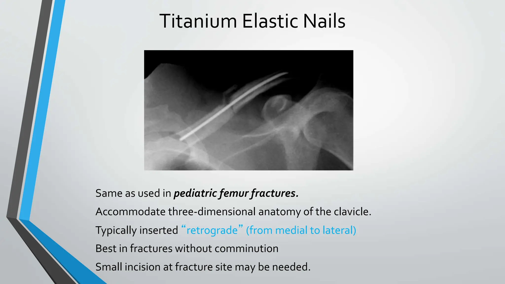 managements of the clavicle fracture.pptx