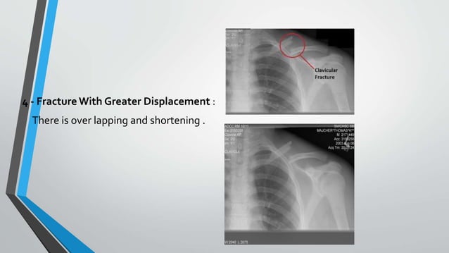managements of the clavicle fracture.pptx