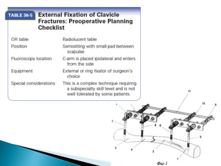 MANAGEMENT_OF_CLAVICLE_FRACTURE_AND_ACROMIOCLAVICULAR_INJURY 2.pptx