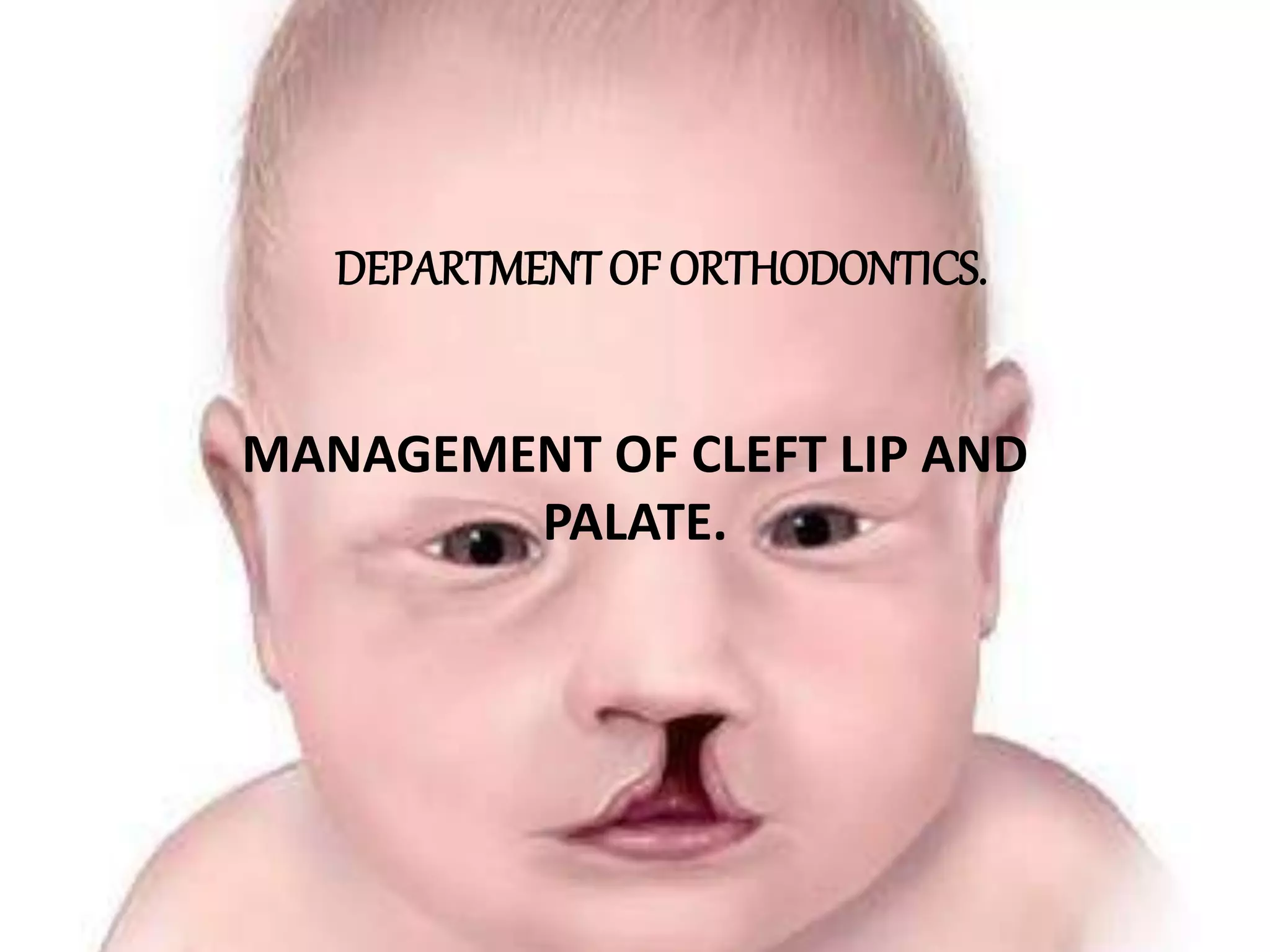 Management of cleft lip and palate | PPTX