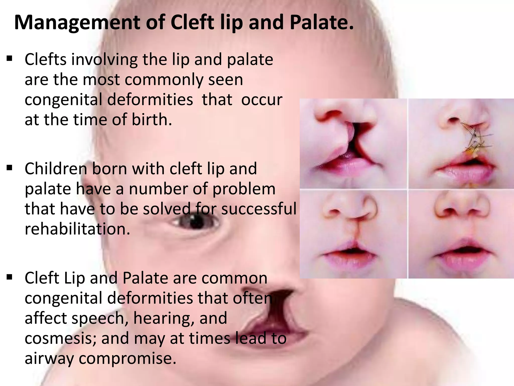 Management of cleft lip and palate | PPTX