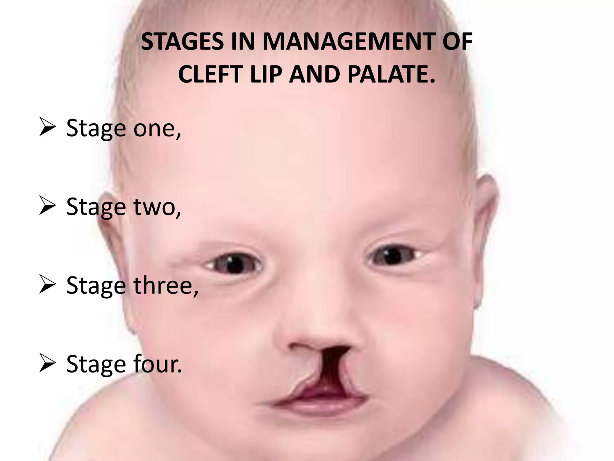 Management of cleft lip and palate | PPTX