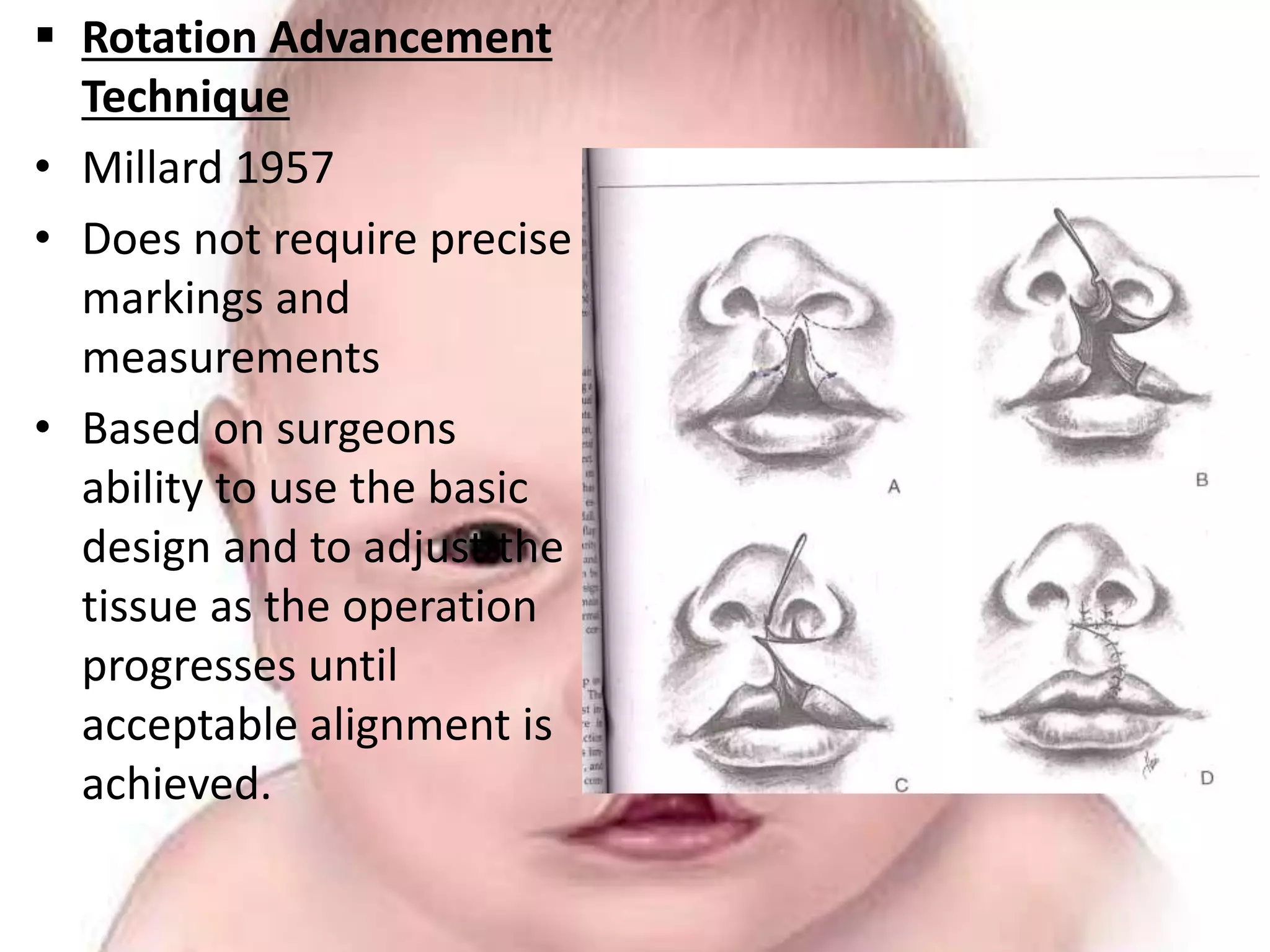 Management of cleft lip and palate | PPTX