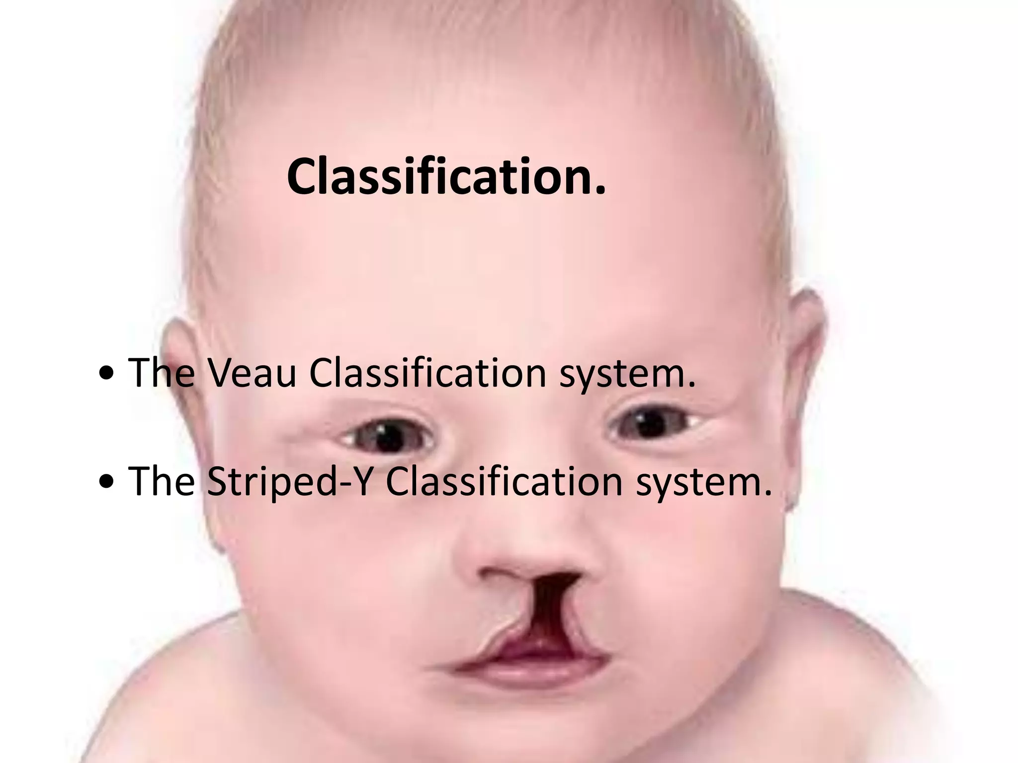Management of cleft lip and palate | PPTX
