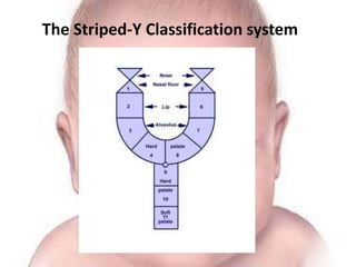 Management of cleft lip and palate | PPTX