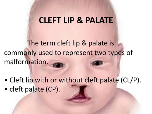 Management of cleft lip and palate | PPT