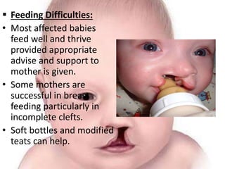Management of cleft lip and palate | PPTX