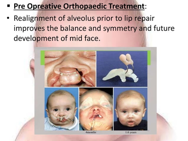 Management of cleft lip and palate | PPT