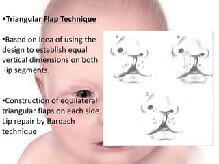 Management of cleft lip and palate | PPTX