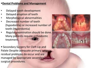 Management of cleft lip and palate | PPTX