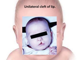 Management of cleft lip and palate | PPTX