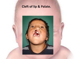 Management of cleft lip and palate | PPTX