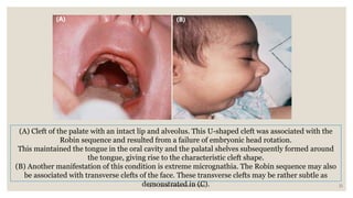 Management of cleft lip and palate | PPTX