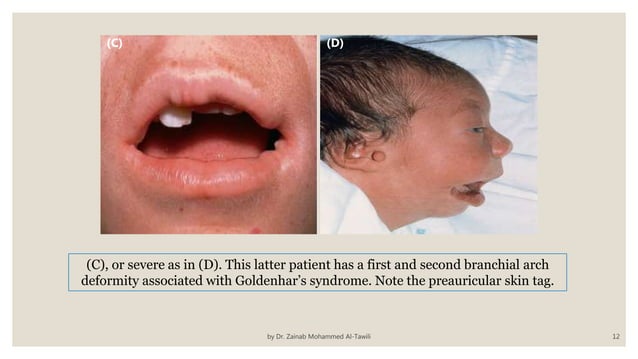 Management of cleft lip and palate | PPTX | Ear, Nose and Throat ...