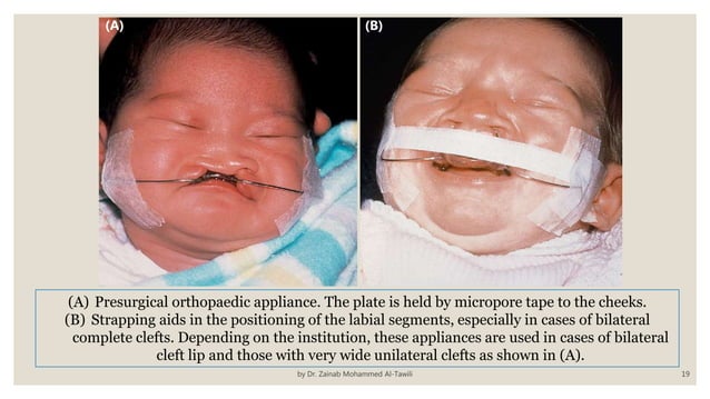 Management of cleft lip and palate | PPTX | Ear, Nose and Throat ...