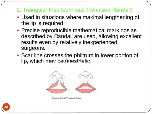 Management of cleft lip and palate