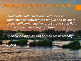Management of cleft lip & palate | PPSX
