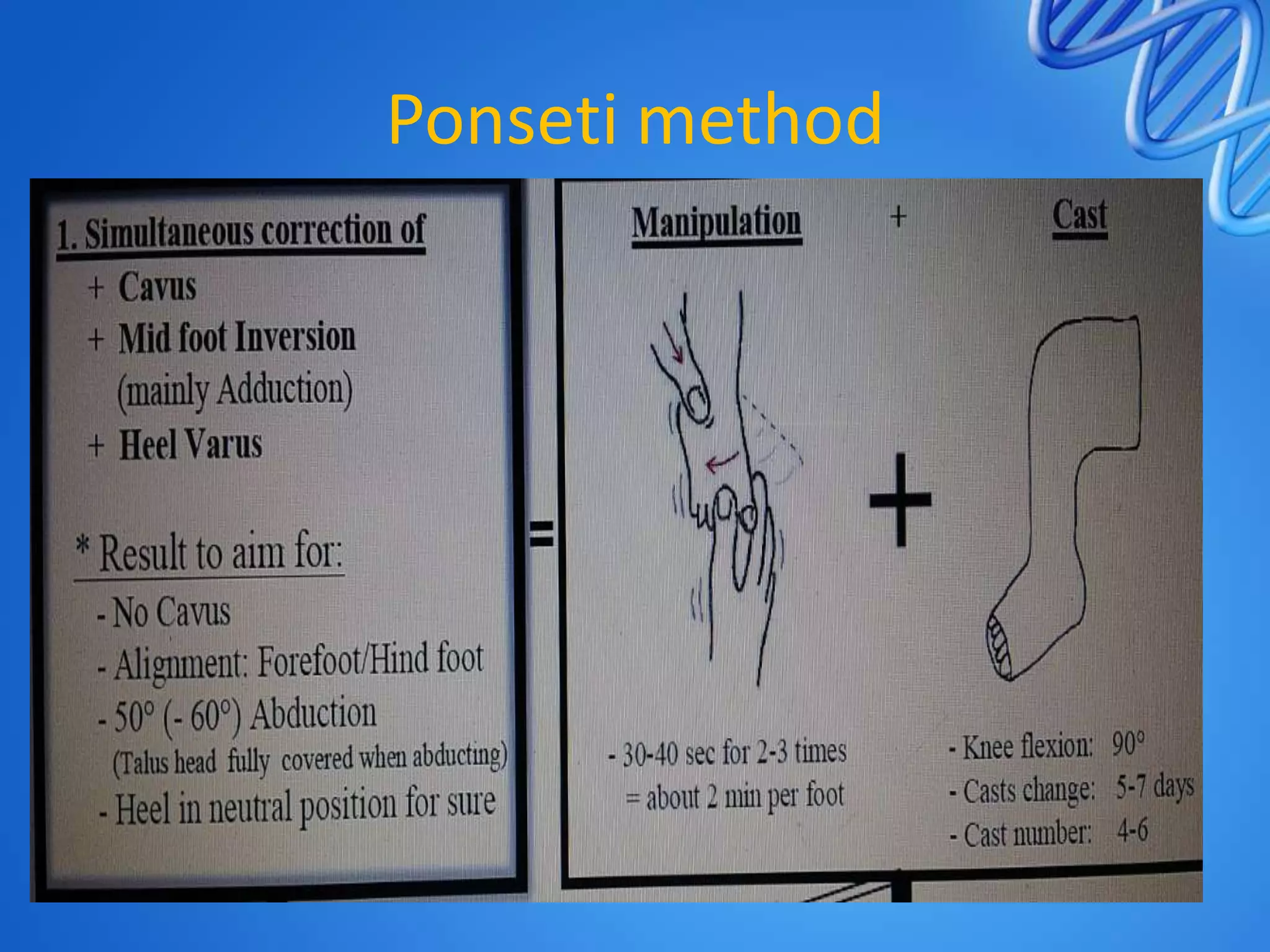 Management of club foot | PPTX