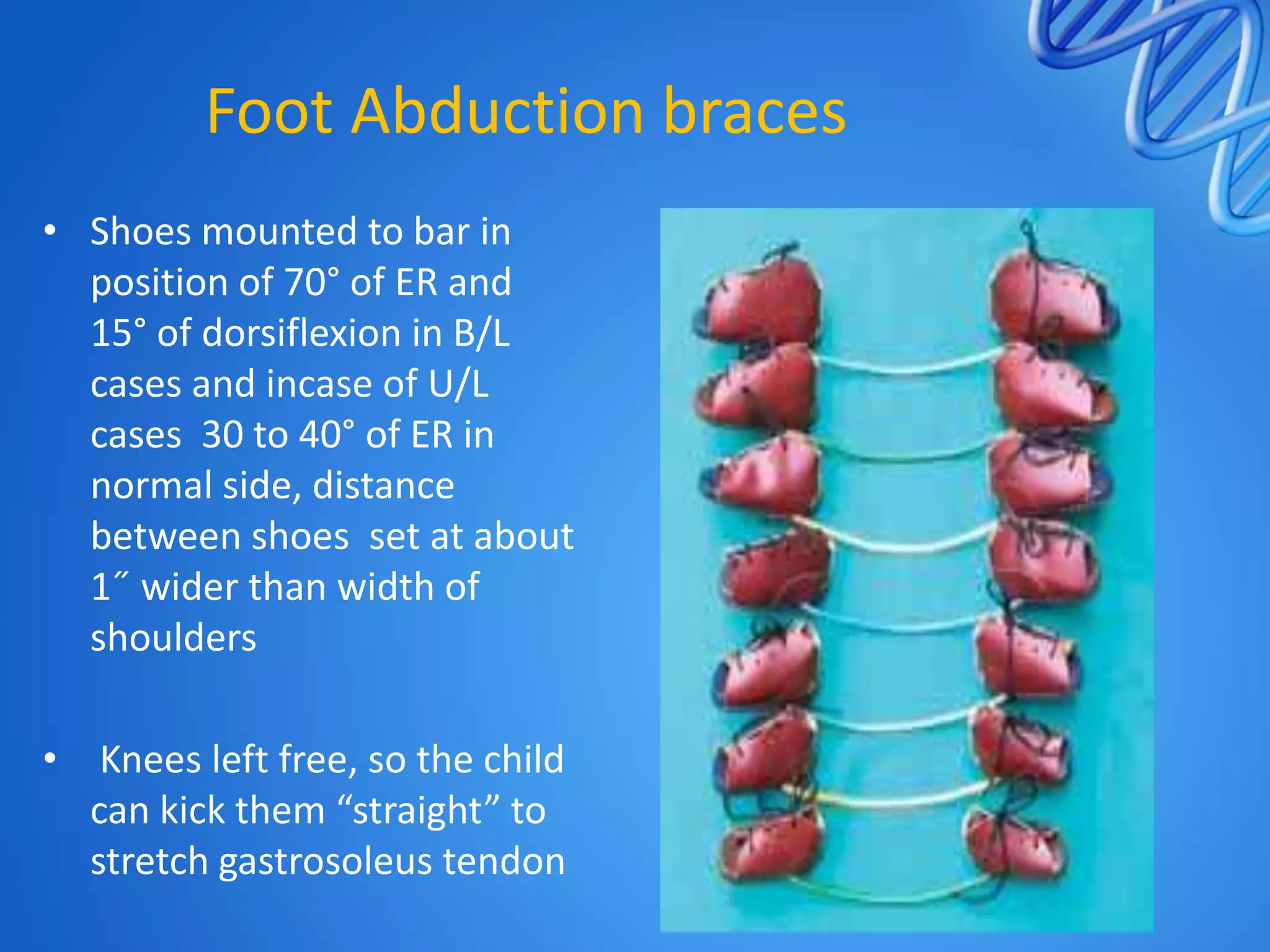 Management of club foot | PPTX