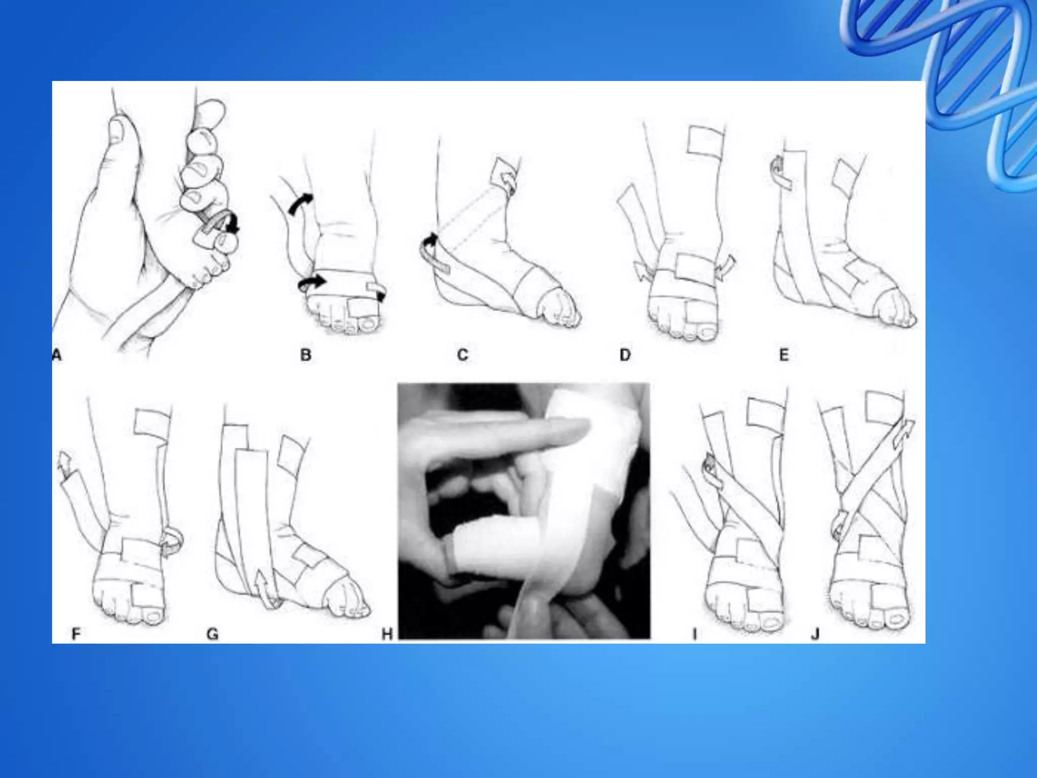 Management of club foot | PPTX