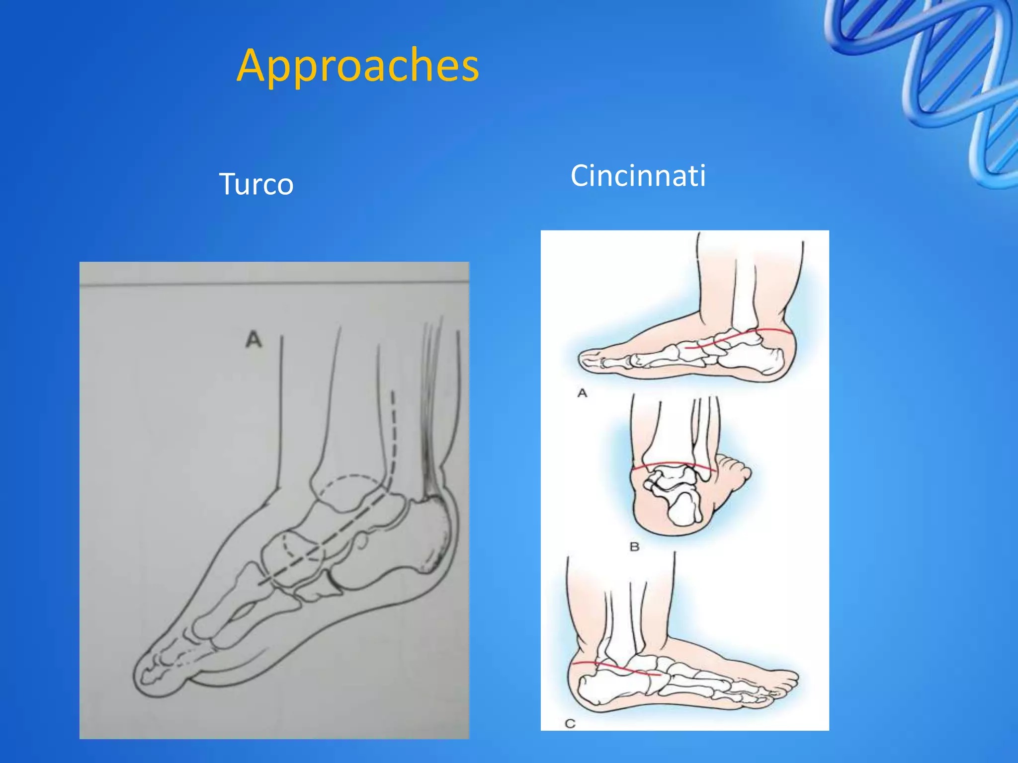 Management of club foot | PPTX