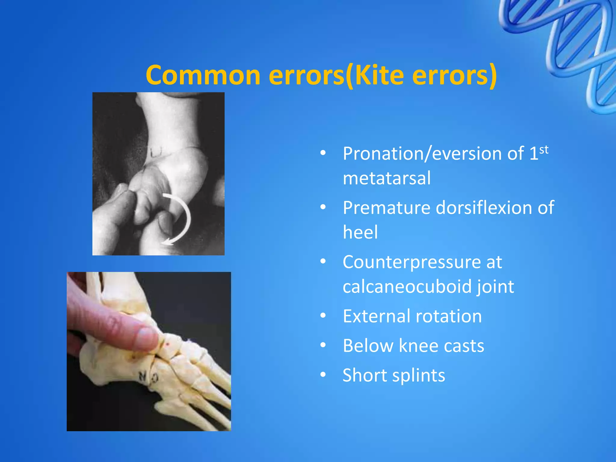 Management of club foot | PPTX