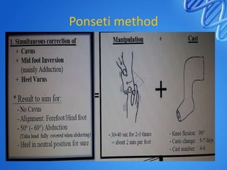 Management of club foot | PPTX